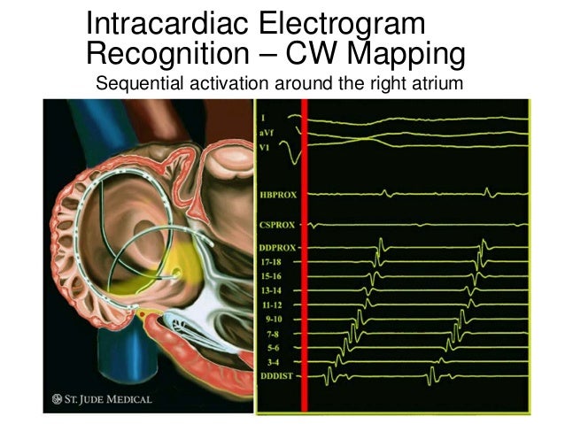 11.atrial flutter for basic ep.final