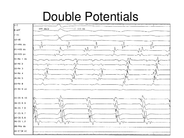11 Atrial Flutter For Basic Ep Final In 2020 Atrial Flutter Cardiac