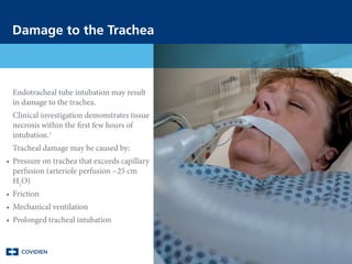 11-AW-0036 SA_ET Intubation and Tracheal Damage.pdf