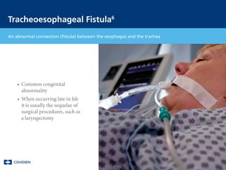 11-AW-0036 SA_ET Intubation and Tracheal Damage.pdf