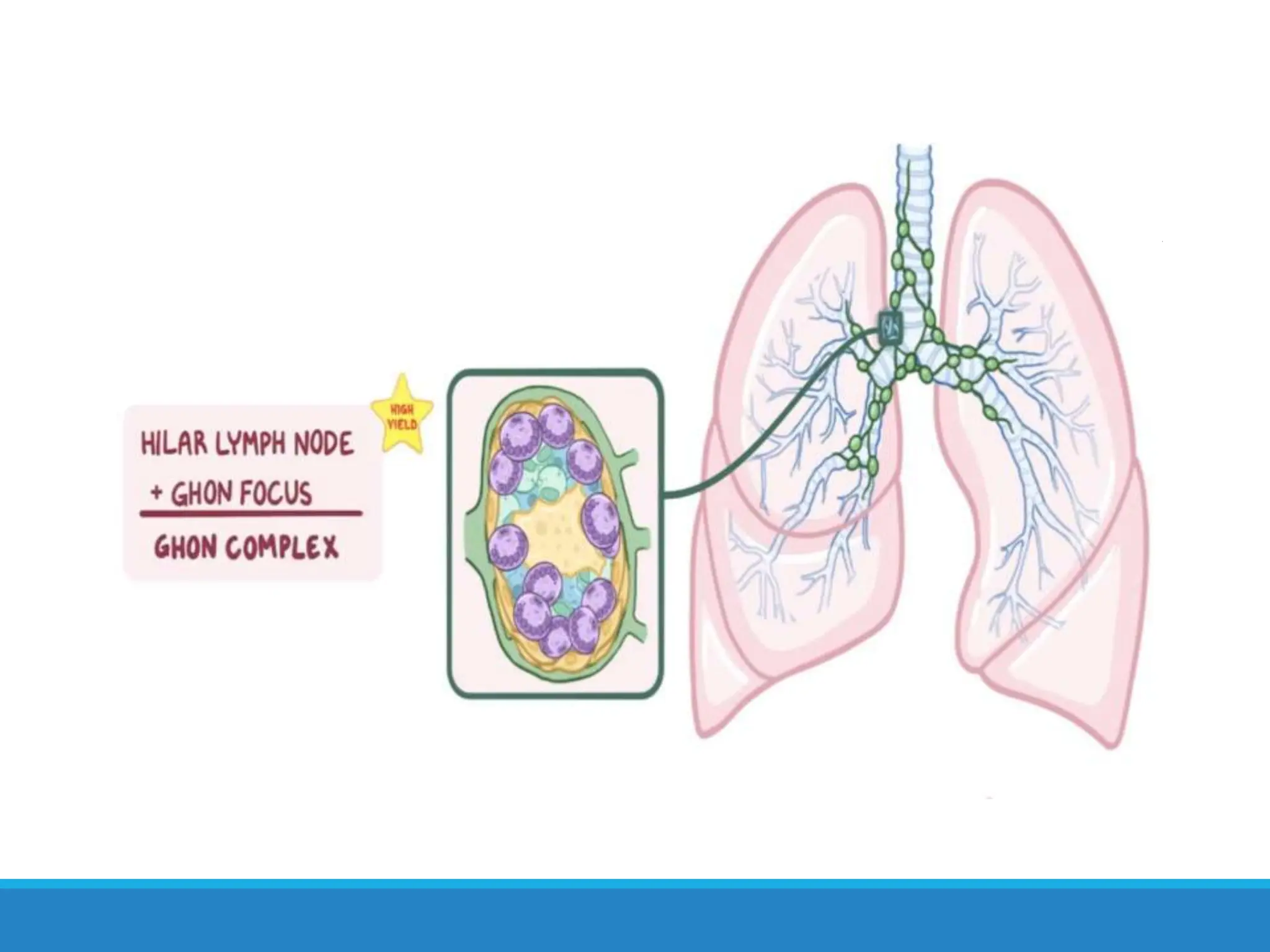 11- Chronic inflammations -Tuberculosis.ppt