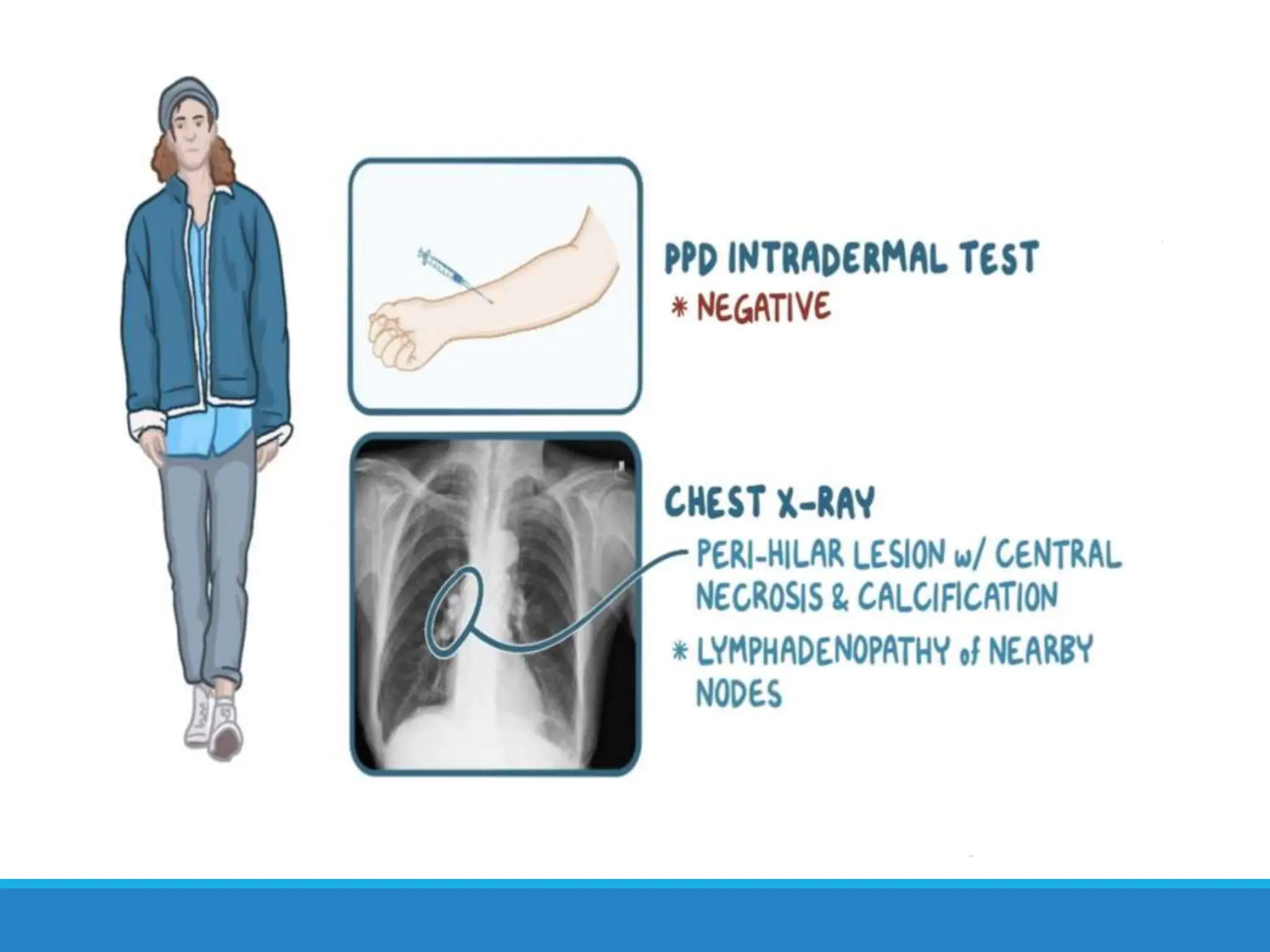 11- Chronic inflammations -Tuberculosis.ppt