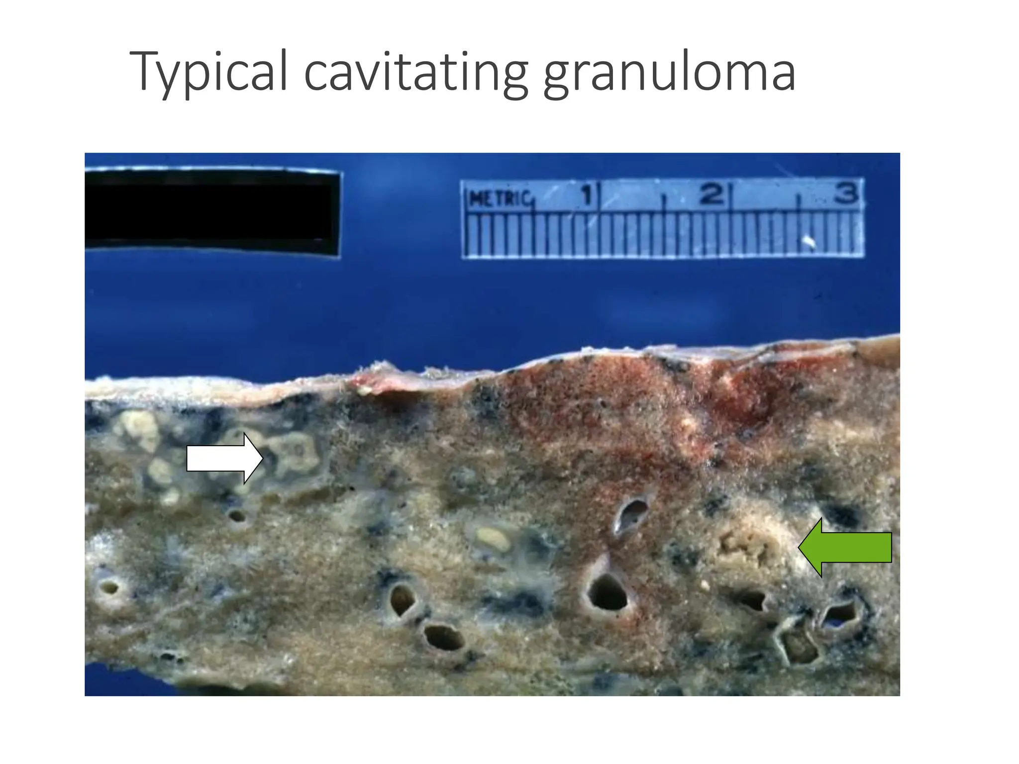 11- Chronic inflammations -Tuberculosis.ppt