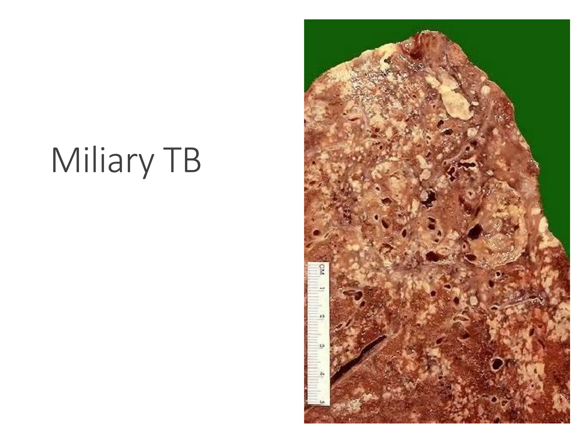 11- Chronic inflammations -Tuberculosis.ppt