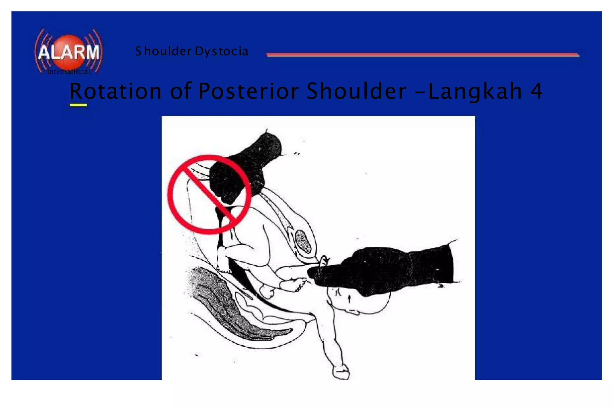 11-distosia-bahuppt.pptx