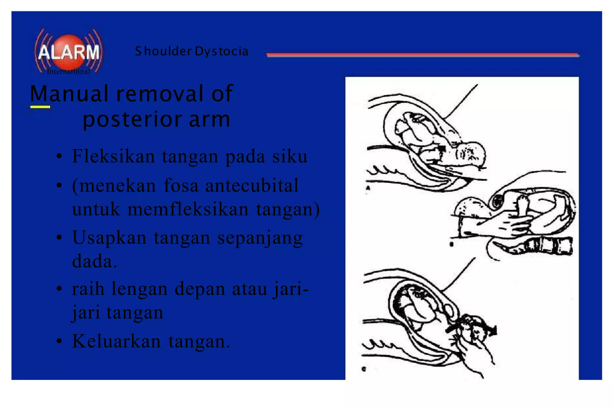 11-distosia-bahuppt.pptx