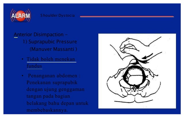 11-distosia-bahuppt.pptx