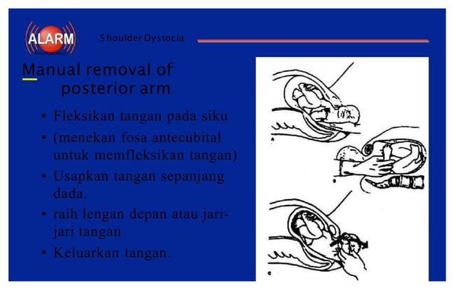 11-distosia-bahuppt.pptx