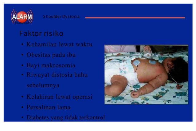 11-distosia-bahuppt.pptx