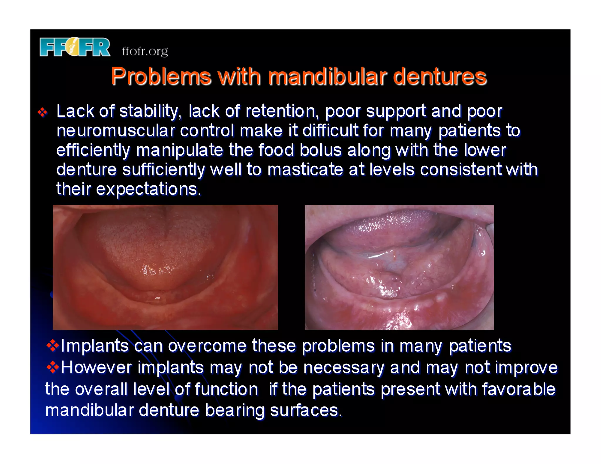 11.edent mand overlay dentures | PDF