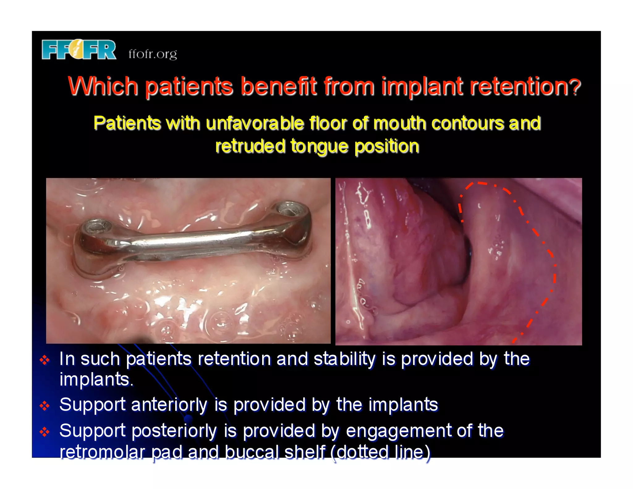 11.edent mand overlay dentures | PDF