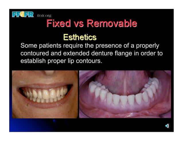 11.edent mand overlay dentures | PDF | Dental Health | Diseases and ...