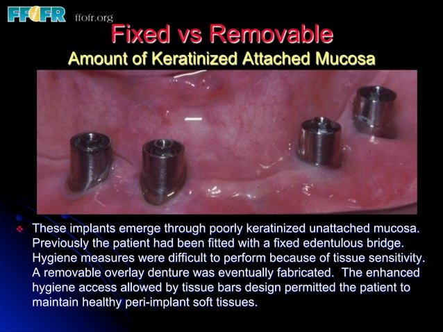 Edentulous Mandible - Overlay Dentures | PPT
