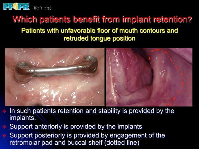 Edentulous Mandible - Overlay Dentures | PPT