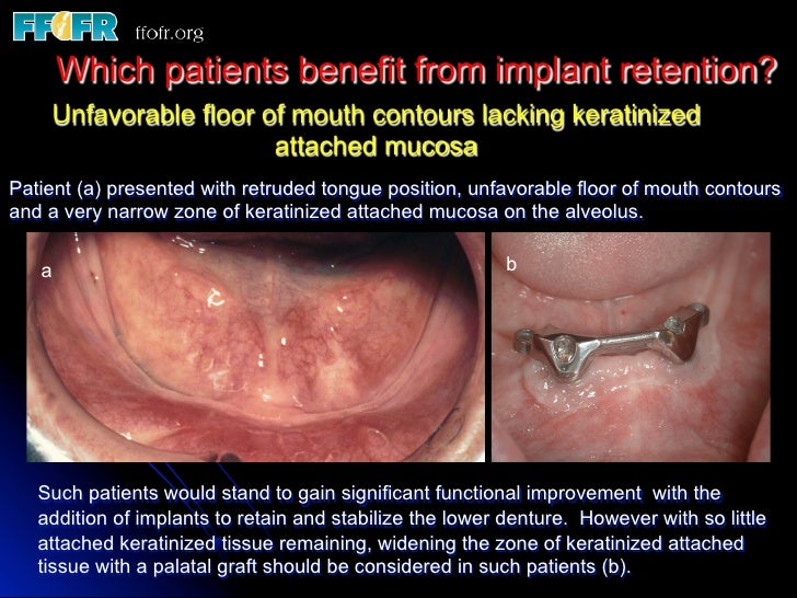 Hamular Notch Edentulous Mouth