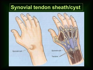 11-Extensor Muscle forearm introduction.ppt