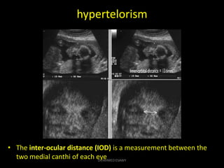 Hypotelorism Ultrasound