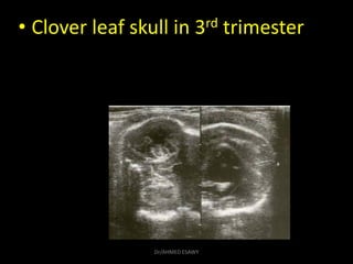 Cloverleaf Skull Ultrasound