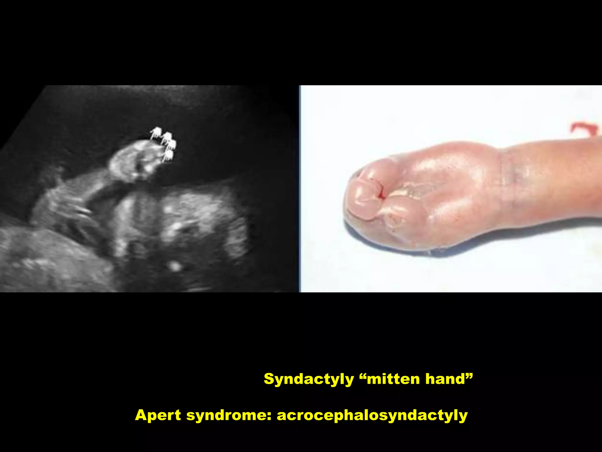 11-Fetal skeletal system part 2 Dr Ahmed Esawy | PPT