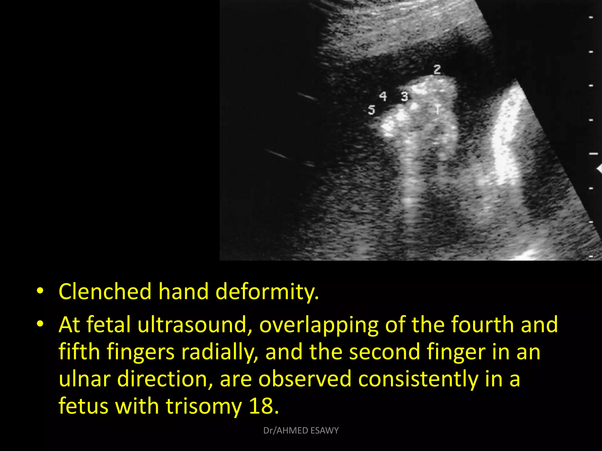 11-Fetal skeletal system part 2 Dr Ahmed Esawy | PPT