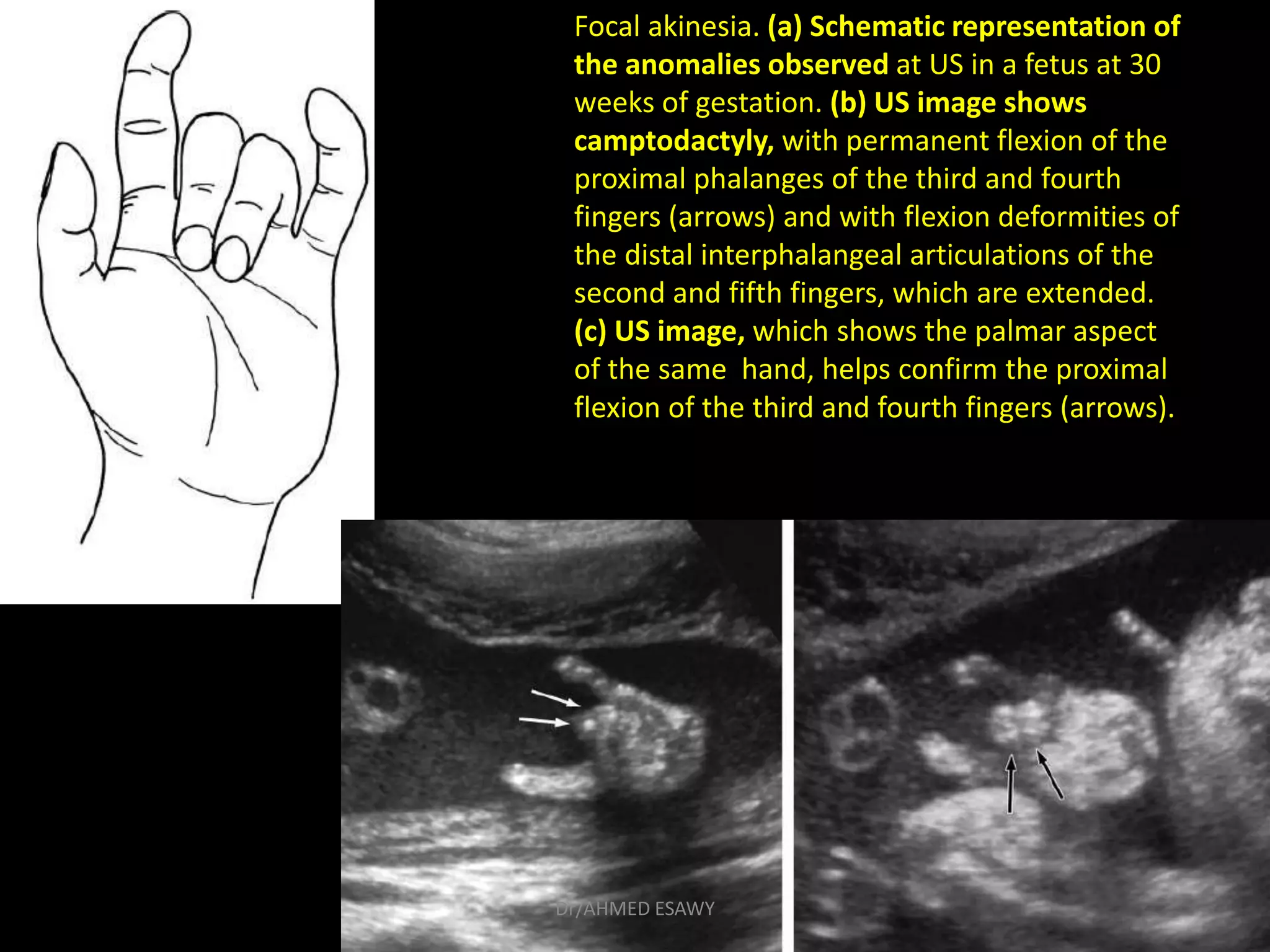 11-Fetal skeletal system part 2 Dr Ahmed Esawy | PPT