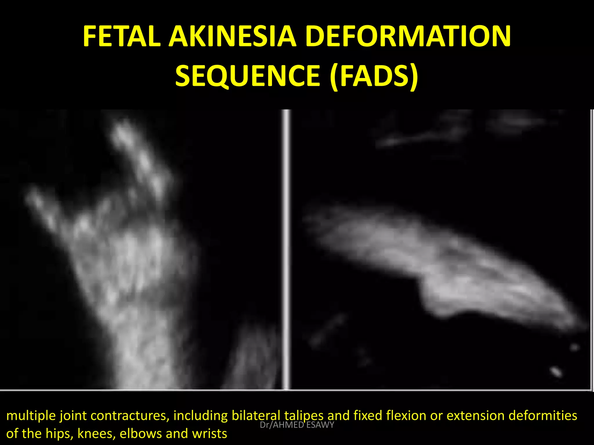 11-Fetal skeletal system part 2 Dr Ahmed Esawy | PPT