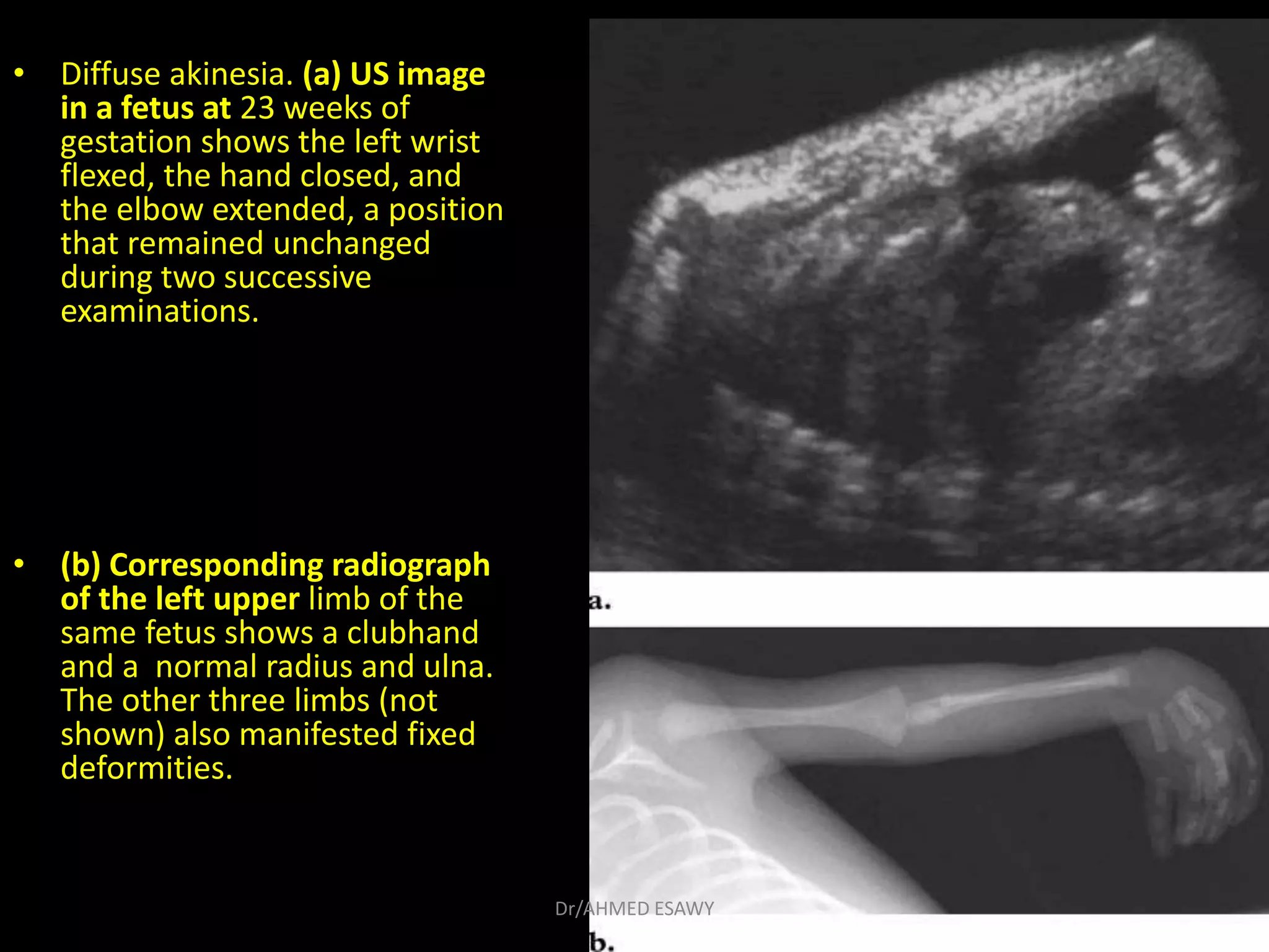 11-Fetal skeletal system part 2 Dr Ahmed Esawy | PPT