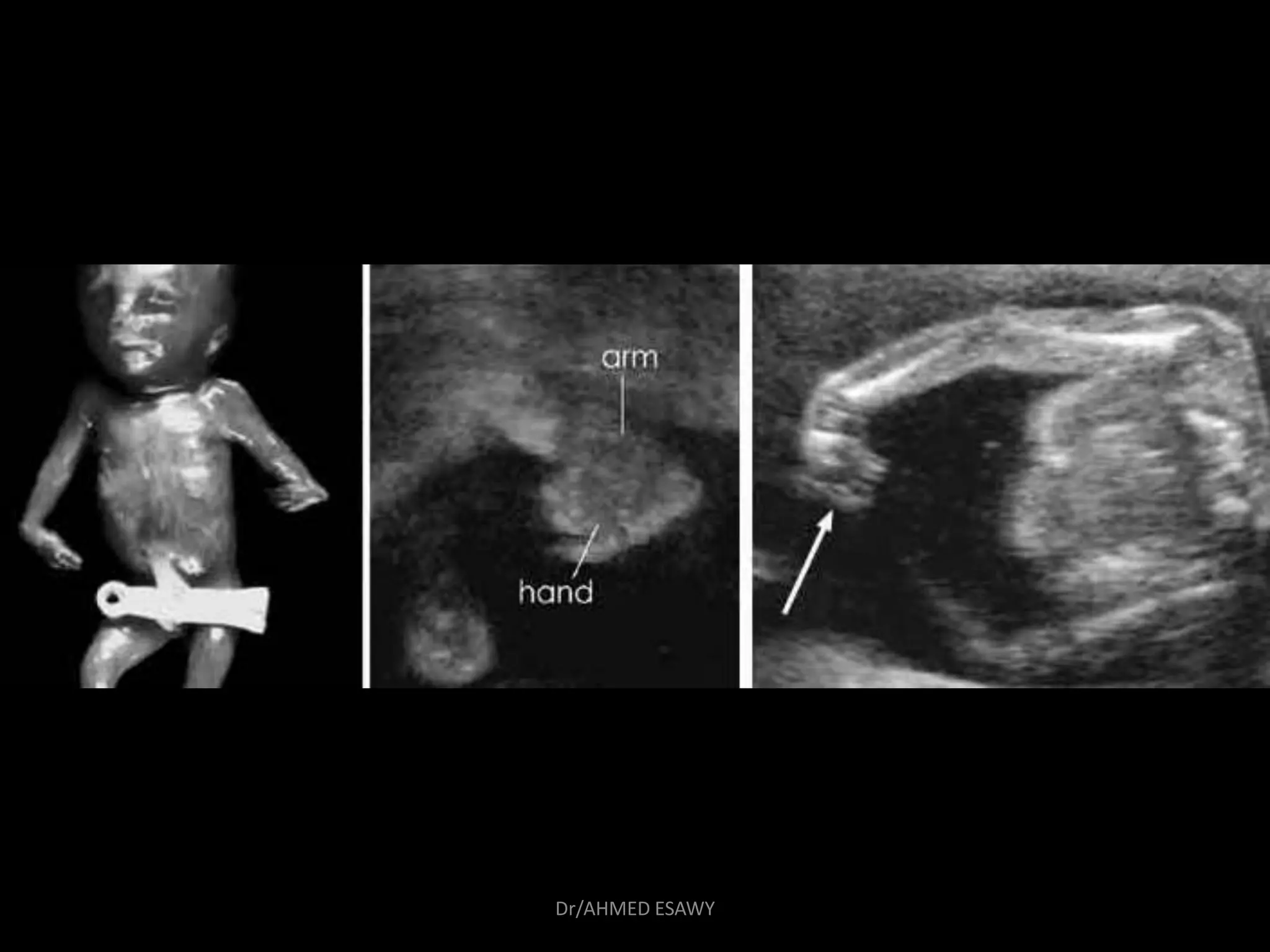 11-Fetal skeletal system part 2 Dr Ahmed Esawy | PPT