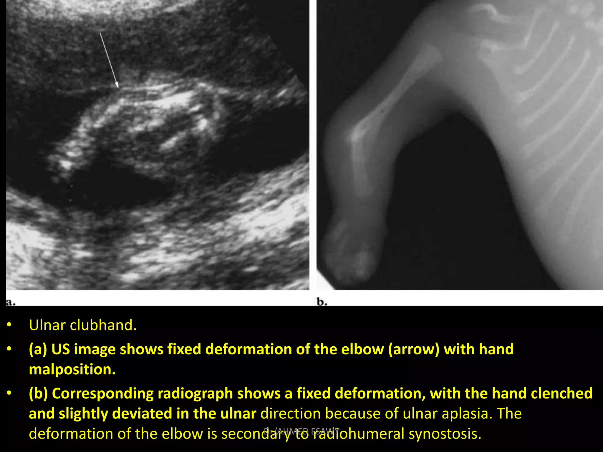 11-Fetal skeletal system part 2 Dr Ahmed Esawy | PPT
