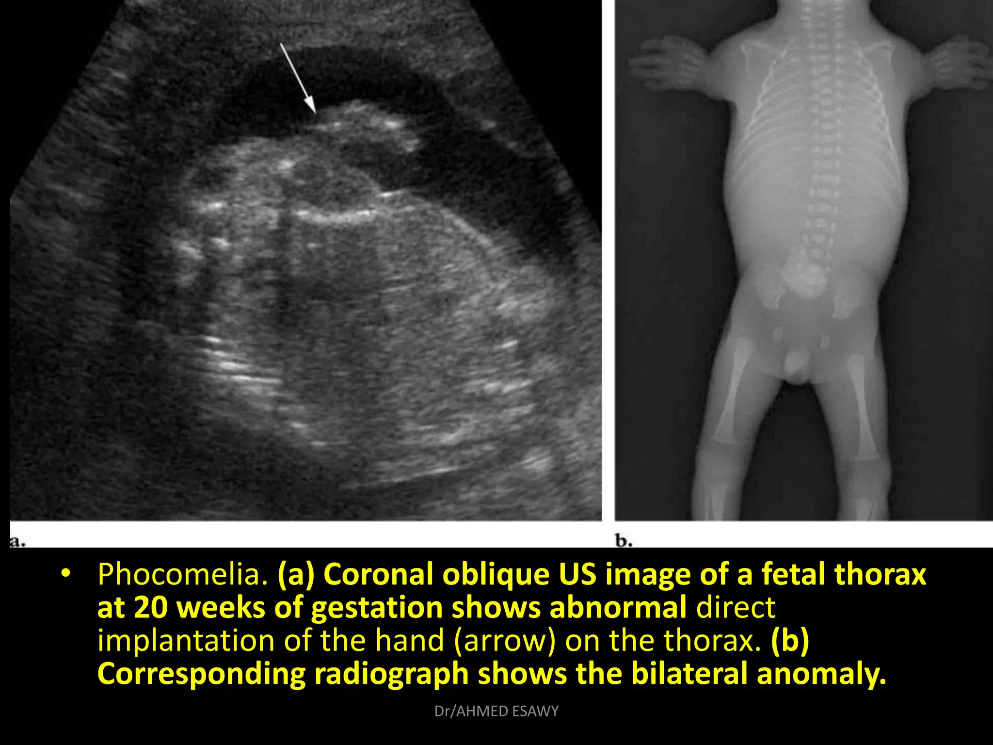 11-Fetal skeletal system part 2 Dr Ahmed Esawy | PPT