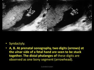 11-Fetal skeletal system part 2 Dr Ahmed Esawy | PDF