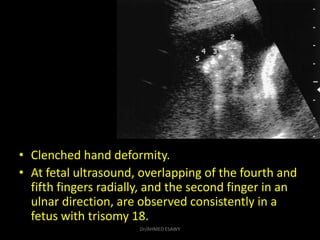 11-Fetal skeletal system part 2 Dr Ahmed Esawy | PDF