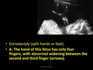 11-Fetal skeletal system part 2 Dr Ahmed Esawy | PDF