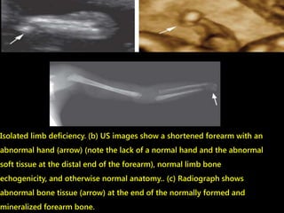 11-Fetal skeletal system part 2 Dr Ahmed Esawy | PDF