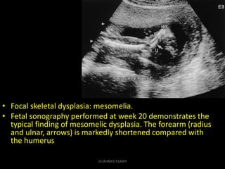 11-Fetal skeletal system part 2 Dr Ahmed Esawy | PDF
