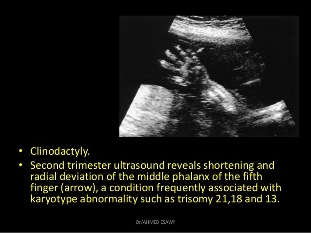 11-Fetal skeletal system part 2 Dr Ahmed Esawy