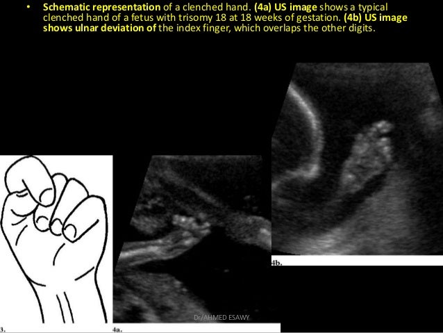 11-Fetal skeletal system part 2 Dr Ahmed Esawy