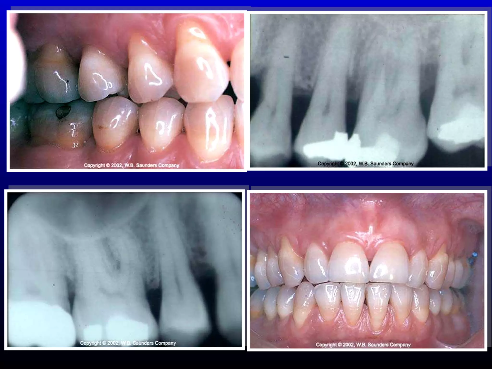 11 from gingivitis to | PPT