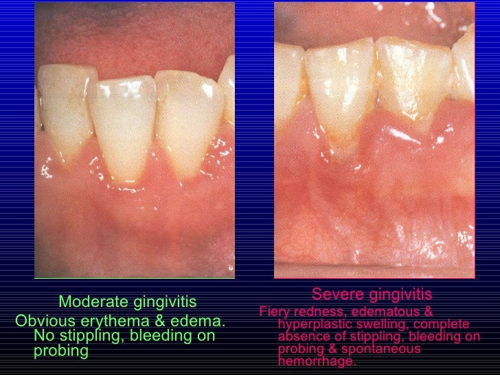 11 from gingivitis to