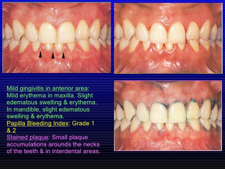 11 from gingivitis to