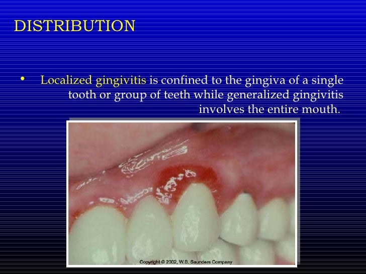 11 from gingivitis to