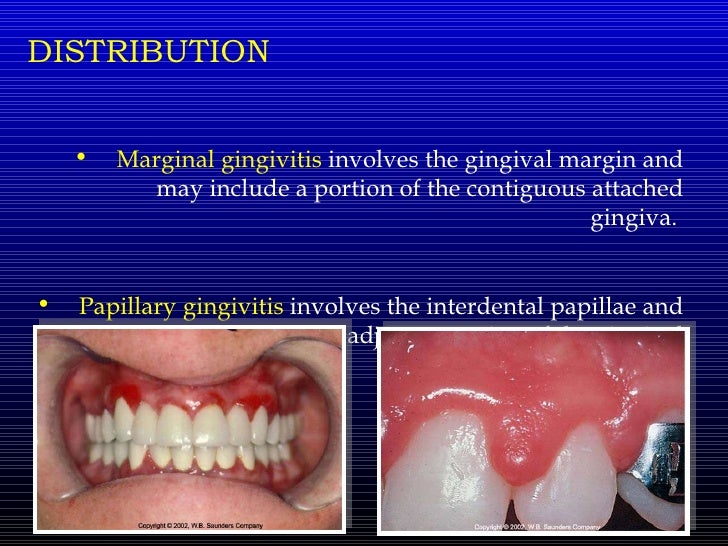 11 from gingivitis to