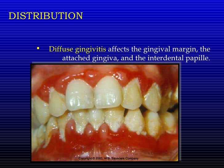 11 from gingivitis to