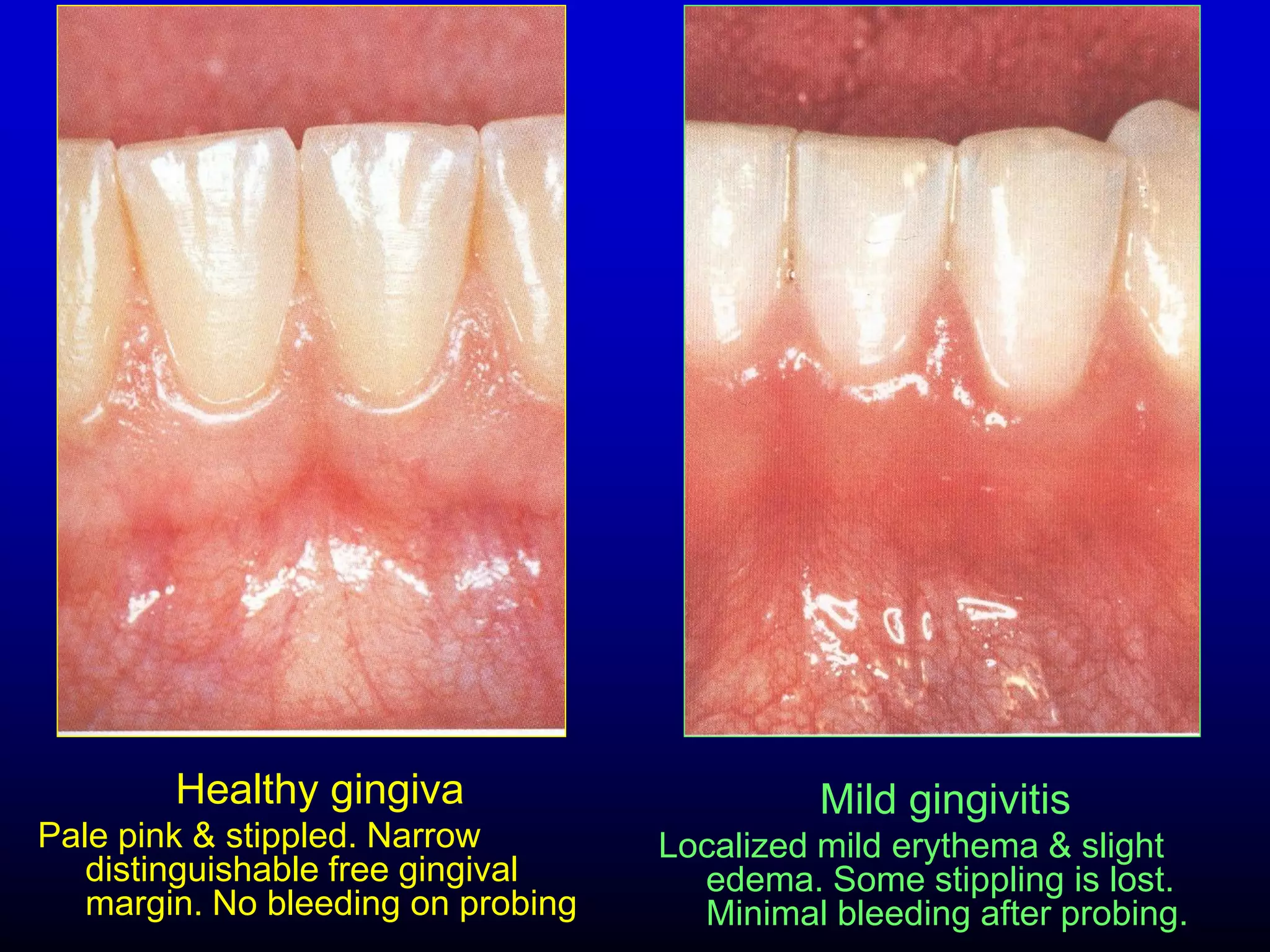 From Gingivitis to Periodontitis | PDF