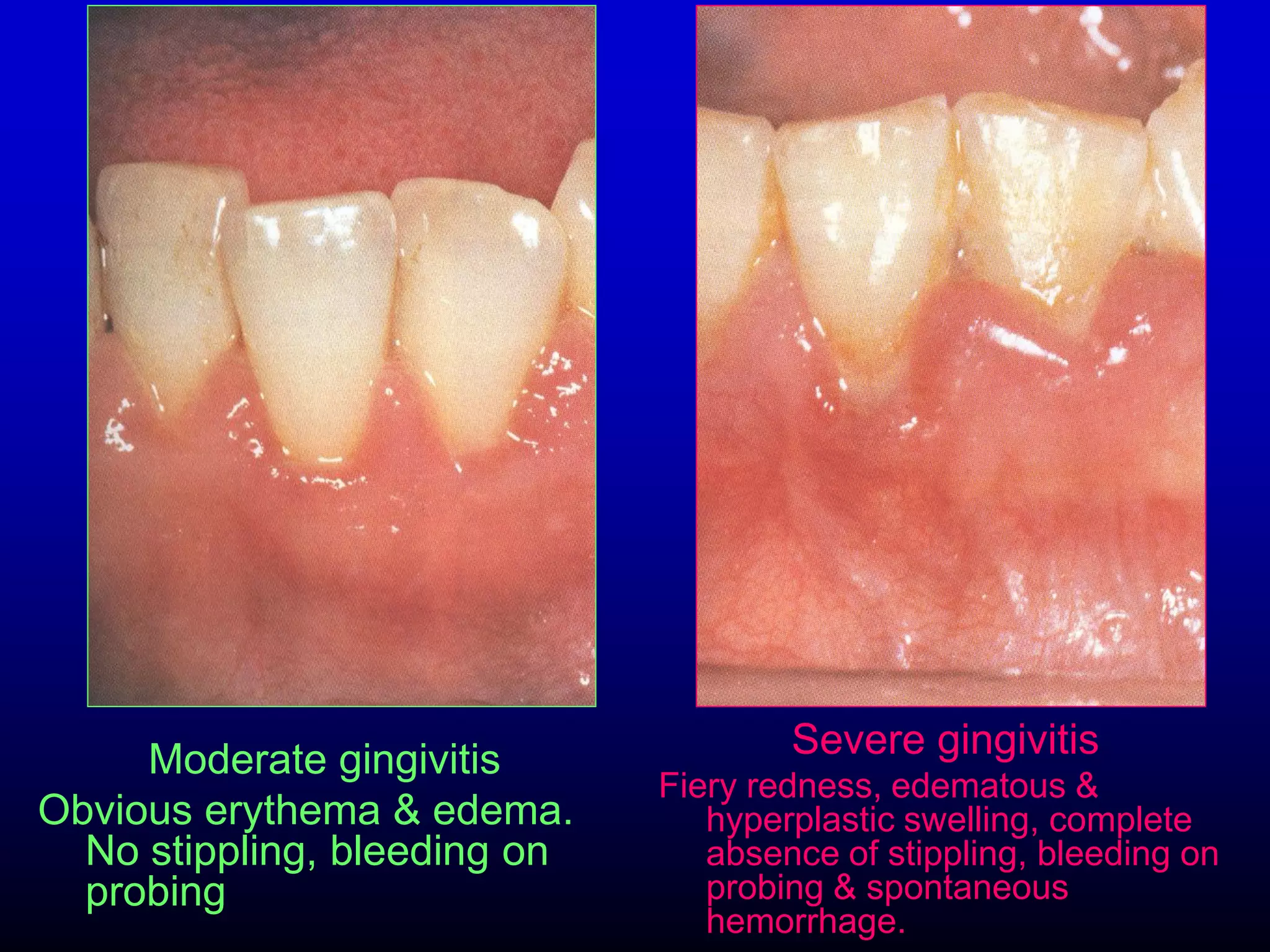 From Gingivitis to Periodontitis | PDF