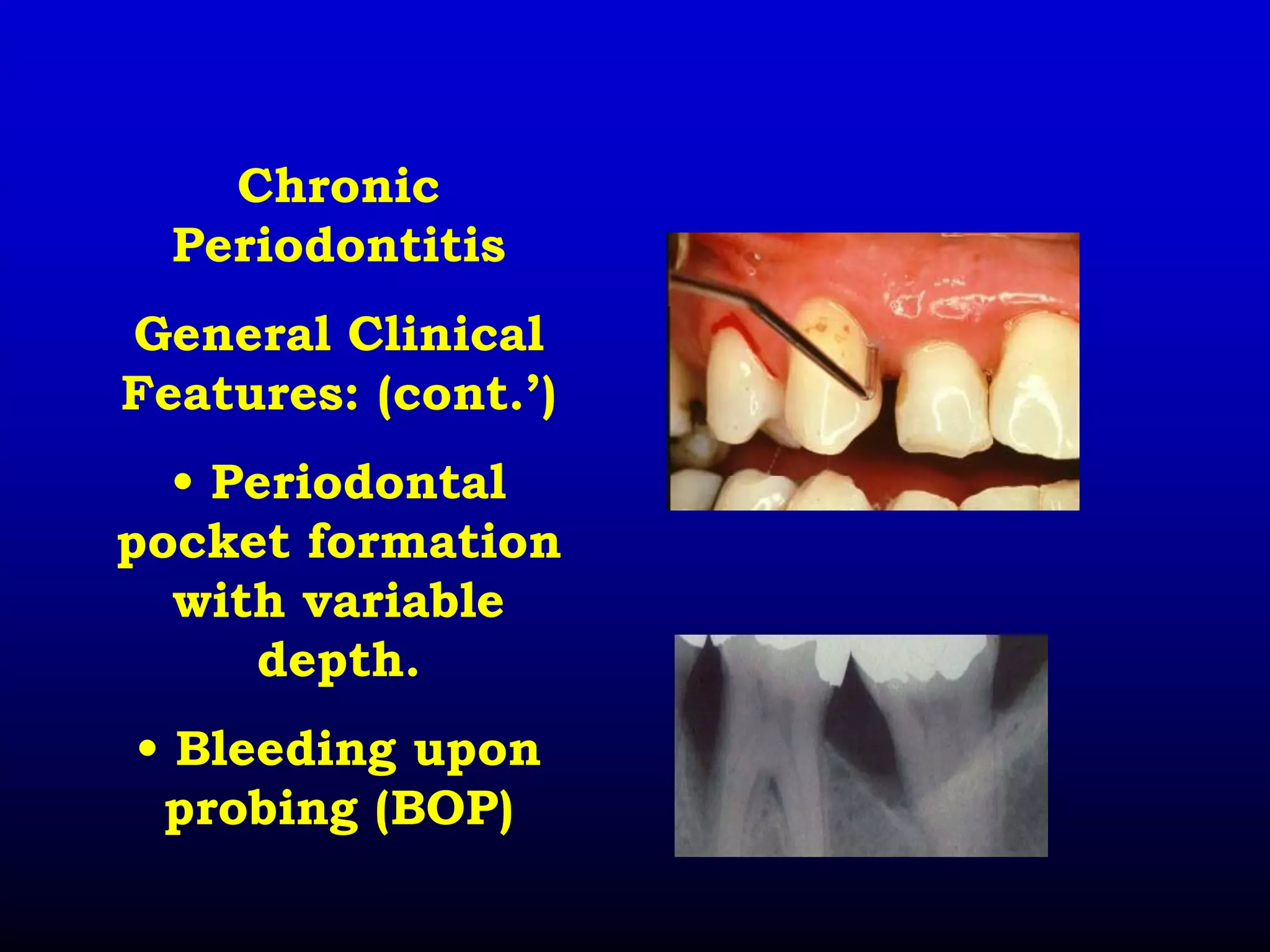 From Gingivitis to Periodontitis | PDF