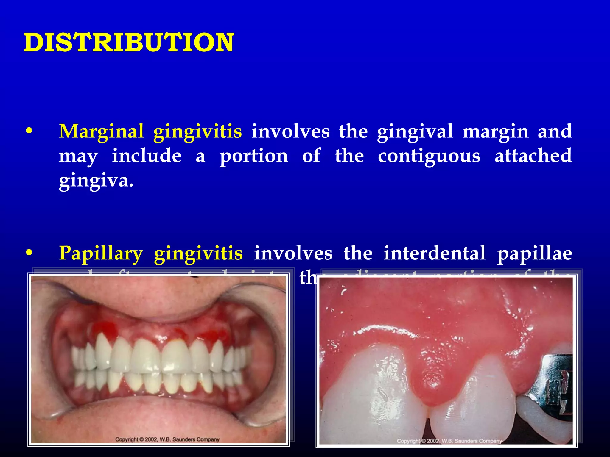 From Gingivitis to Periodontitis | PDF