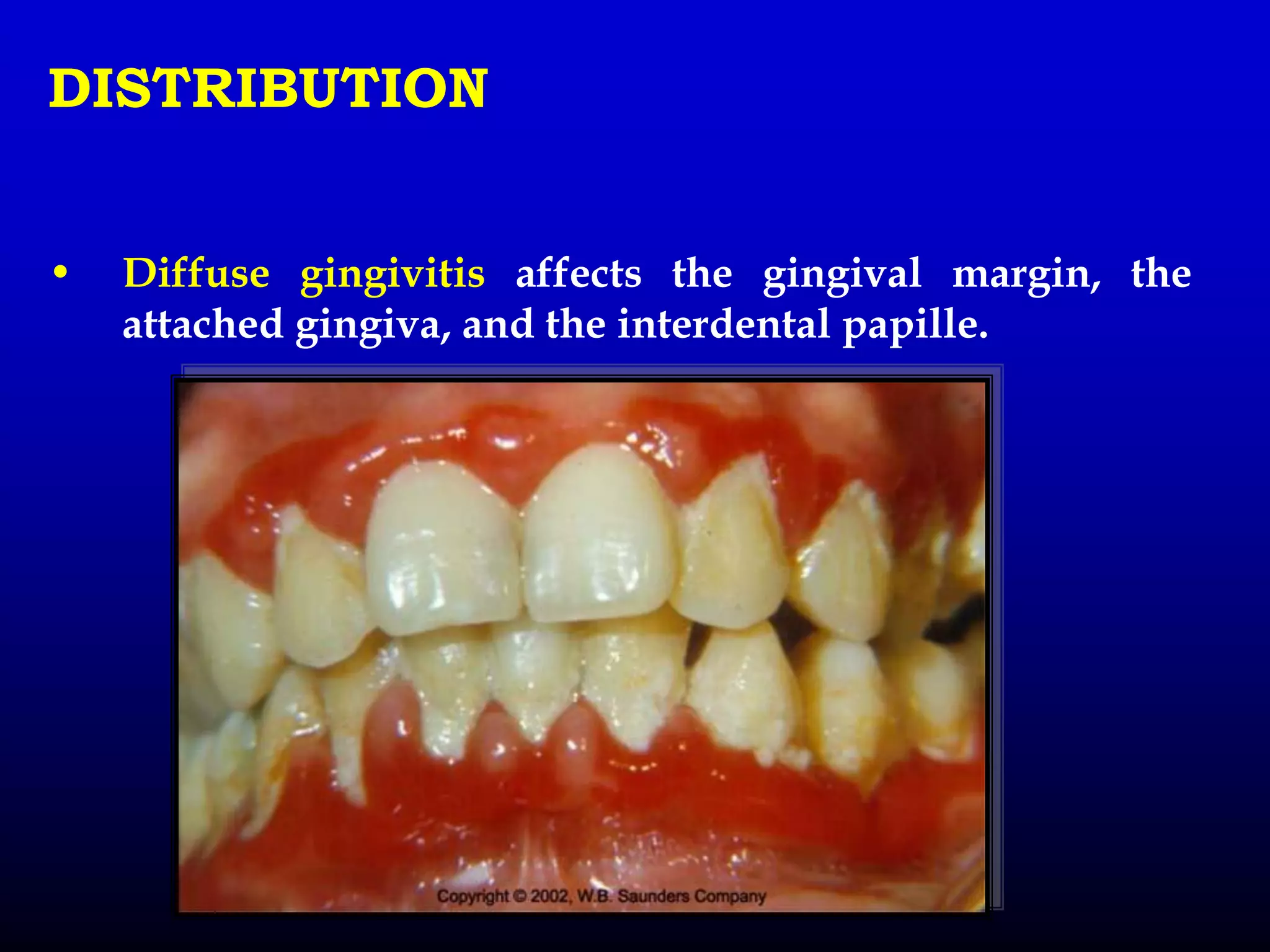From Gingivitis to Periodontitis | PDF