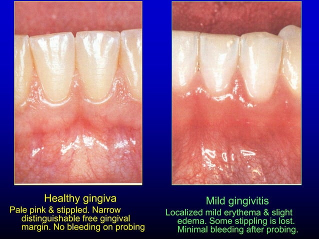 From Gingivitis to Periodontitis | PDF | Dental Health | Diseases and ...