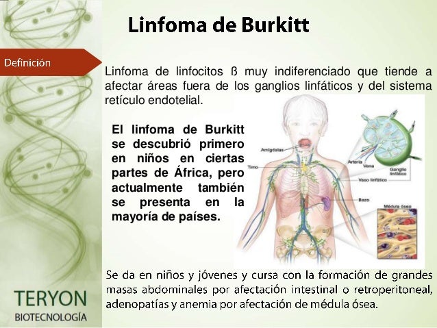 linfoma-de-burkitt